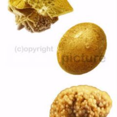 Nierenstein - DocCheck Flexikon