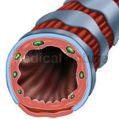 Bronchus - DocCheck Flexikon