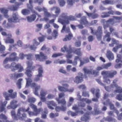 Medulloblastom - DocCheck Flexikon