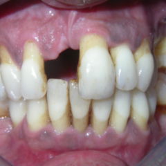 Schneidezahn - DocCheck Flexikon