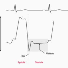 Dip-Plateau-Phänomen - DocCheck Flexikon