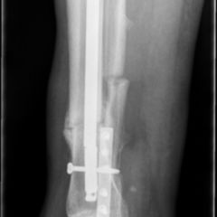 Tibial - DocCheck Flexikon