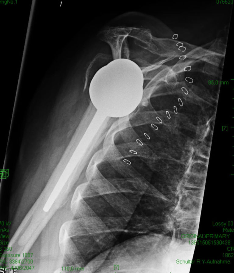 Subkapitale Fraktur nach OP - DocCheck