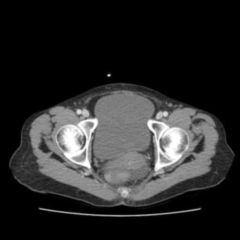 Bridenileus - DocCheck Flexikon