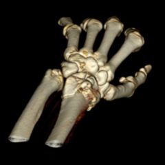 Distale Radiusfraktur - DocCheck Flexikon