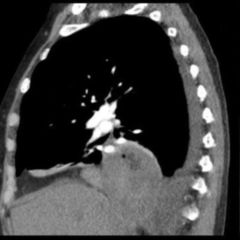 Mediastinitis - DocCheck Flexikon