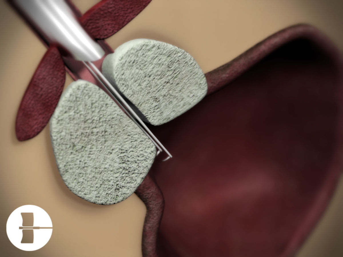 Transurethral resection of the prostate - close up - DocCheck
