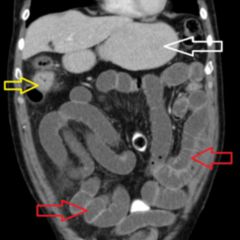 Kolonflexur - DocCheck Flexikon