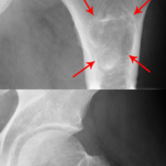 Enchondrom - DocCheck Flexikon