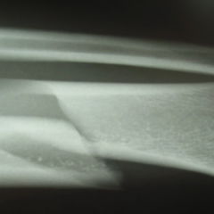 Offene Cholezystektomie - DocCheck Flexikon