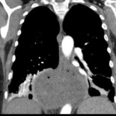 Mediastinitis - DocCheck Flexikon