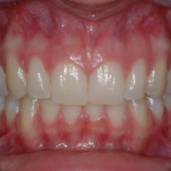 Gingiva - DocCheck Flexikon