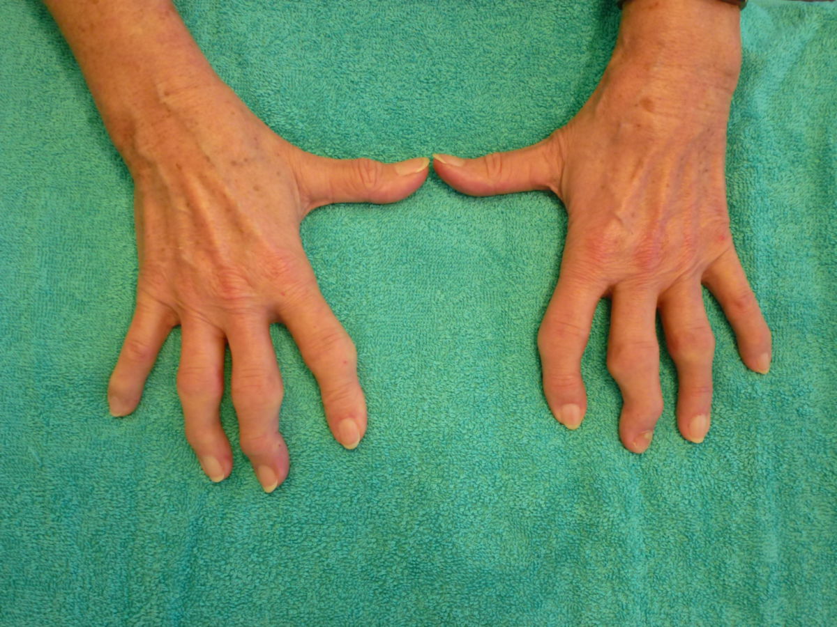 Heberden-Bouchard - DocCheck