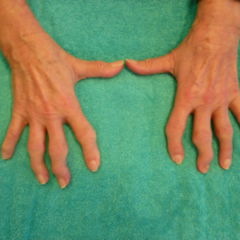 Bouchard-Arthrose - DocCheck Flexikon