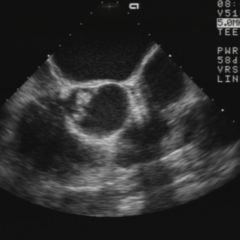 Endokarditis - DocCheck Flexikon