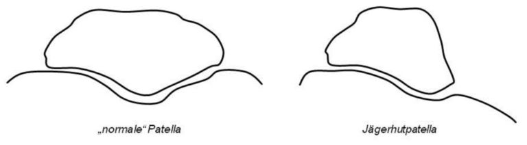 Jägerhut patella (patella type V after Wiberg): comparison - DocCheck