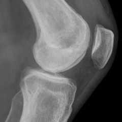 Meniskusläsion - DocCheck Flexikon