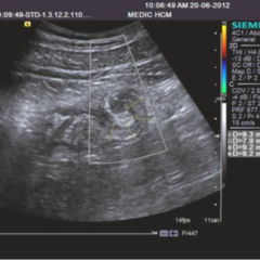 Appendizitis - DocCheck Flexikon