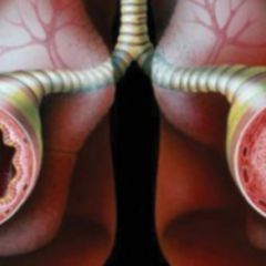 Asthma-Trias - DocCheck Flexikon