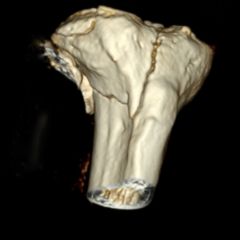 Tibiakopffraktur - DocCheck Flexikon