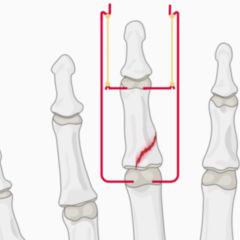 Suzuki-Fixateur - DocCheck Flexikon