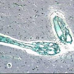 Nucleus caudatus - DocCheck Flexikon