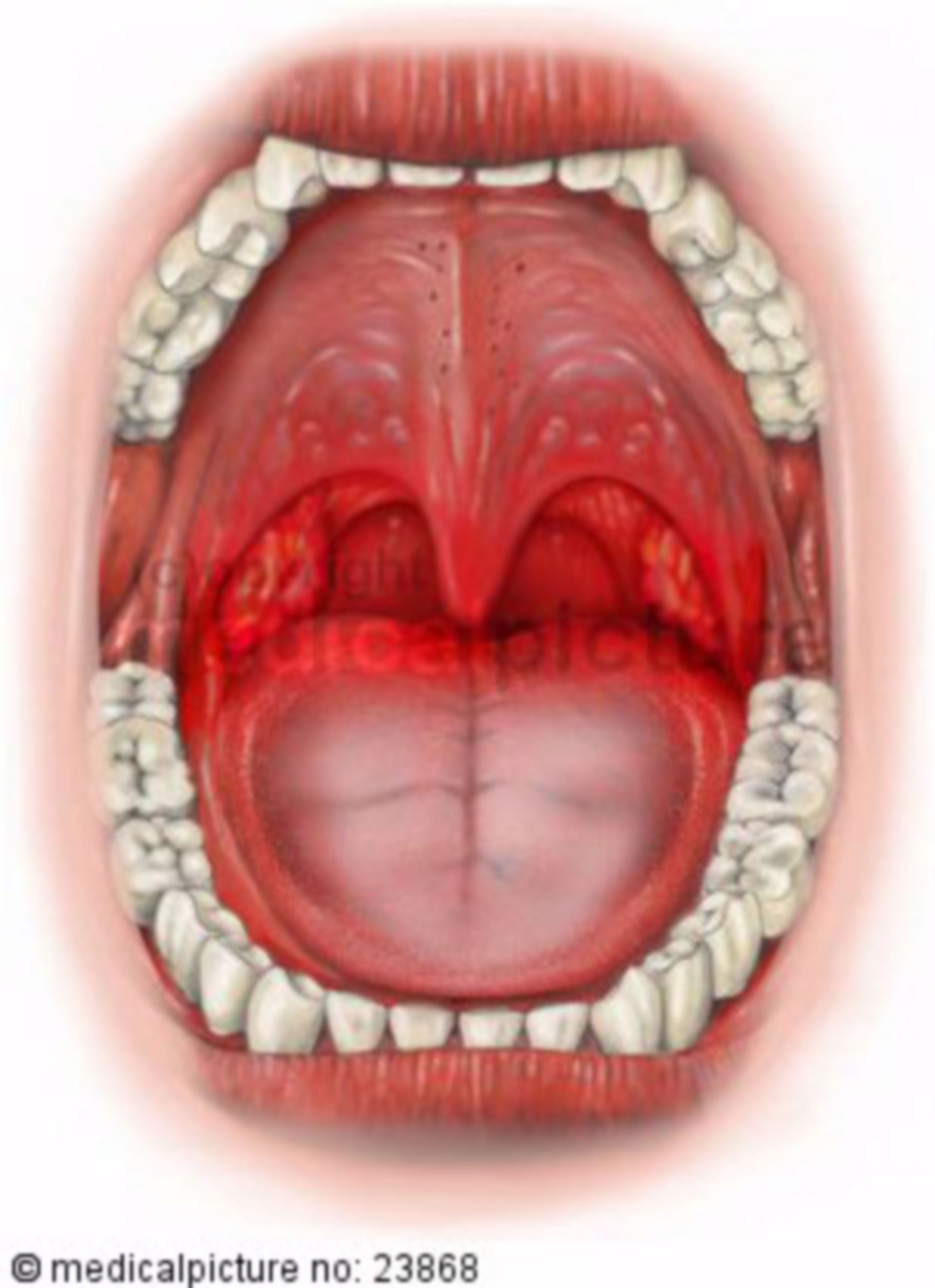 Mandelentz ndung Tonsillitis DocCheck Mandelentz ndung Tonsillitis DocCheck