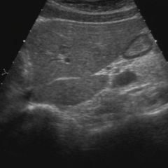 Nucleus caudatus - DocCheck Flexikon