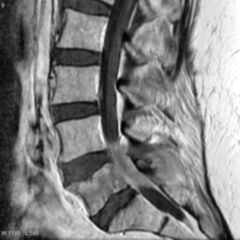 L5-Syndrom - DocCheck Flexikon