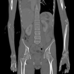 Knochenfenster - DocCheck Flexikon