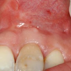 Ankylose - DocCheck Flexikon