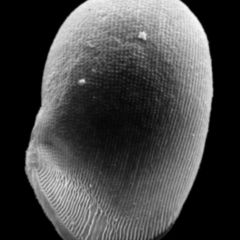 Herniation Pit - DocCheck Flexikon