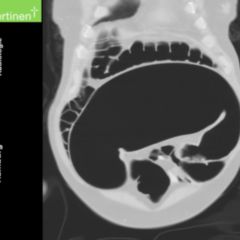 Volvulus - DocCheck Flexikon