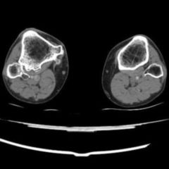 Osteom - DocCheck Flexikon