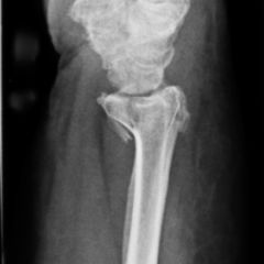 Distale Radiusfraktur - DocCheck Flexikon