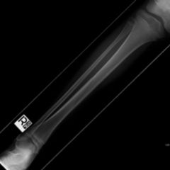 Spiralfraktur - DocCheck Flexikon