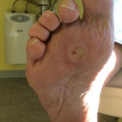 Clavus - DocCheck Flexikon