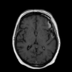 Posteriorinfarkt Klinische Unterscheidungskriterien Ischämischer Und