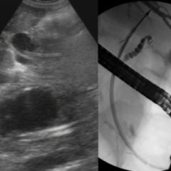 Ductus choledochus - DocCheck Flexikon