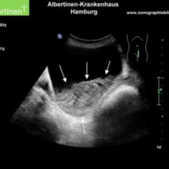 Harnblase - DocCheck Flexikon