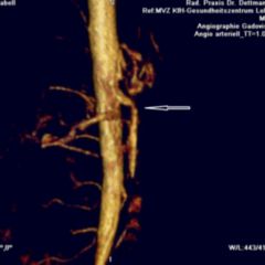Truncus thyrocervicalis - DocCheck Flexikon