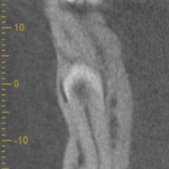 Eckzahn - DocCheck Flexikon