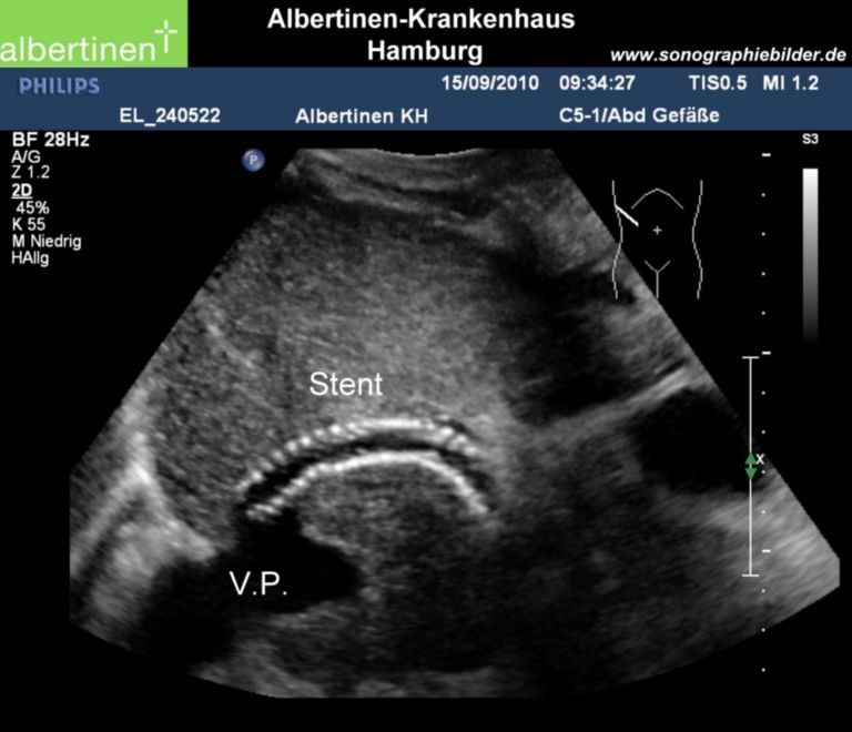 Transjugular Intrahepatic Portosystemic Shunt Ultrasound