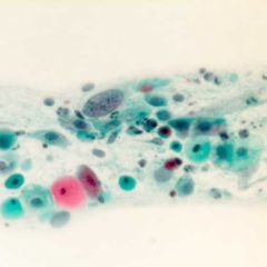 Vaginitis - DocCheck Flexikon