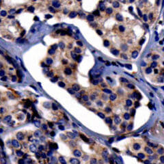 Knochenmetastase - DocCheck Flexikon