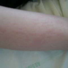 Morbus Still des Erwachsenen - DocCheck Flexikon