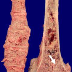 Knochenmetastase - DocCheck Flexikon