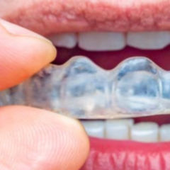 Bruxismus - DocCheck Flexikon