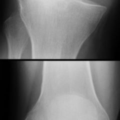 Gonarthrose - DocCheck Flexikon