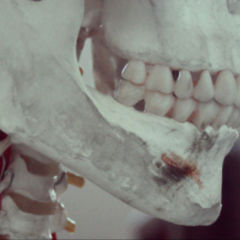 Karies - DocCheck Flexikon